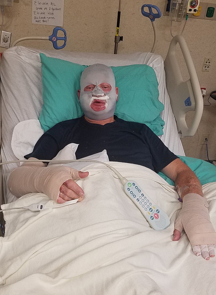 Wisconsin Man Severely Burned By Fire Urges Caution Around Flames - WPR